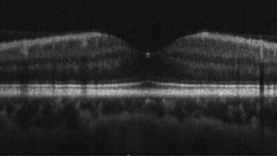 What Is Spectral Domain OCT? Uses and applications - Ibsen Photonics