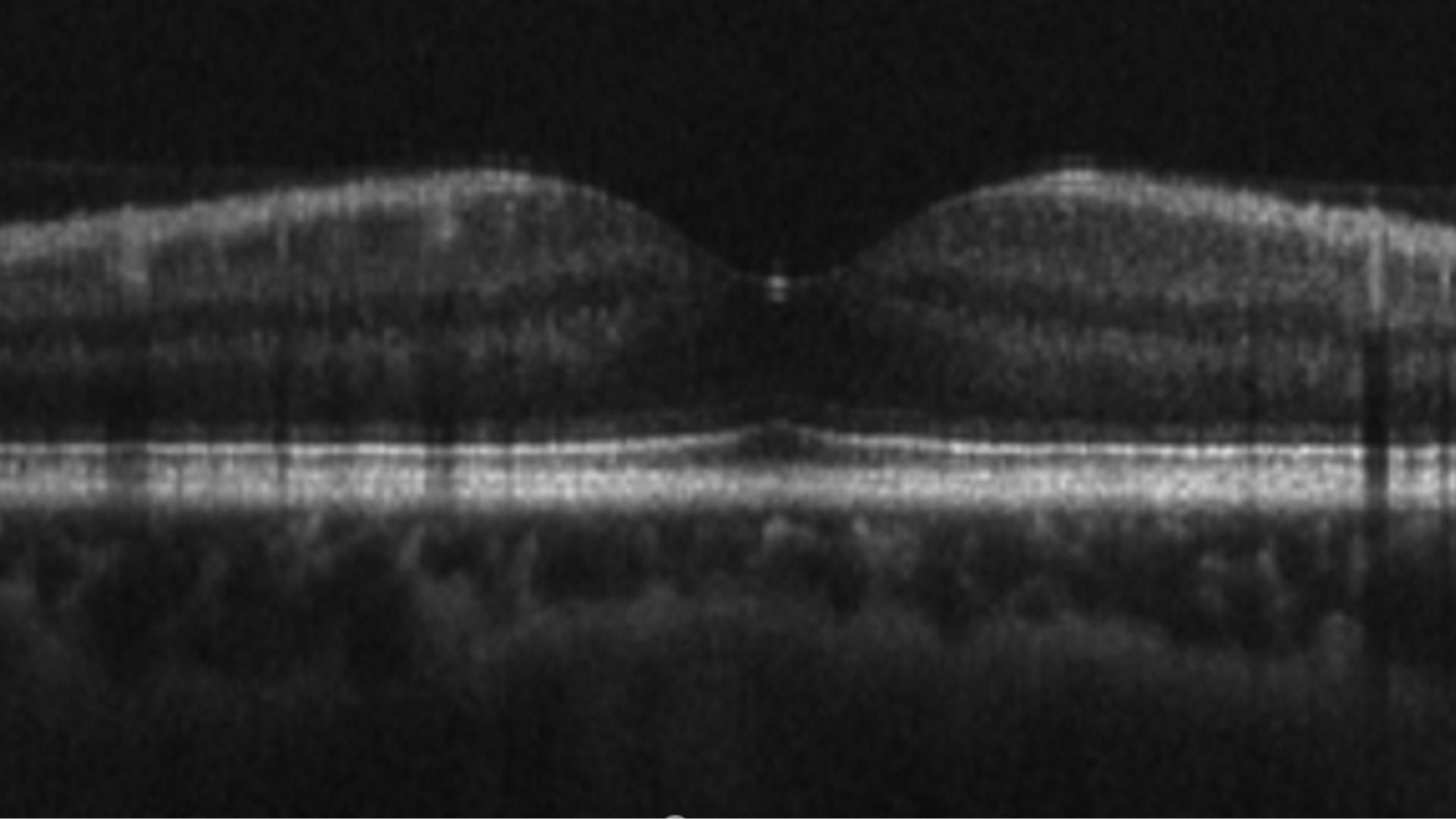 What Is Spectral Domain OCT? Uses and applications - Ibsen Photonics